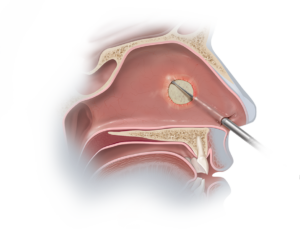 Sinonasal Repair | Biodesign® Rhinology Products