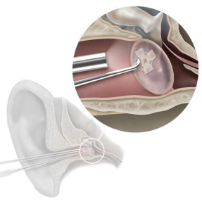 Biodesign® Otologic Butterfly Graft – Everis